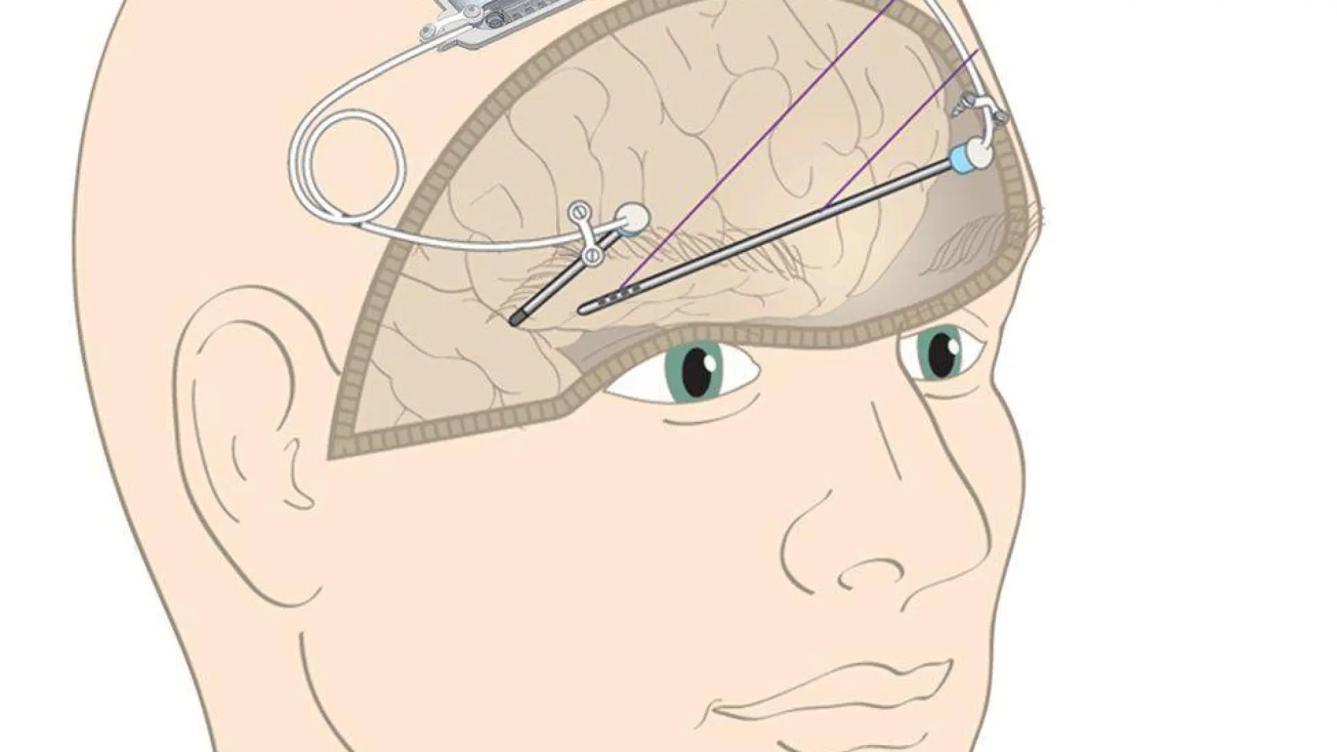 Un implante cerebral podría revertir los síntomas del párkinson