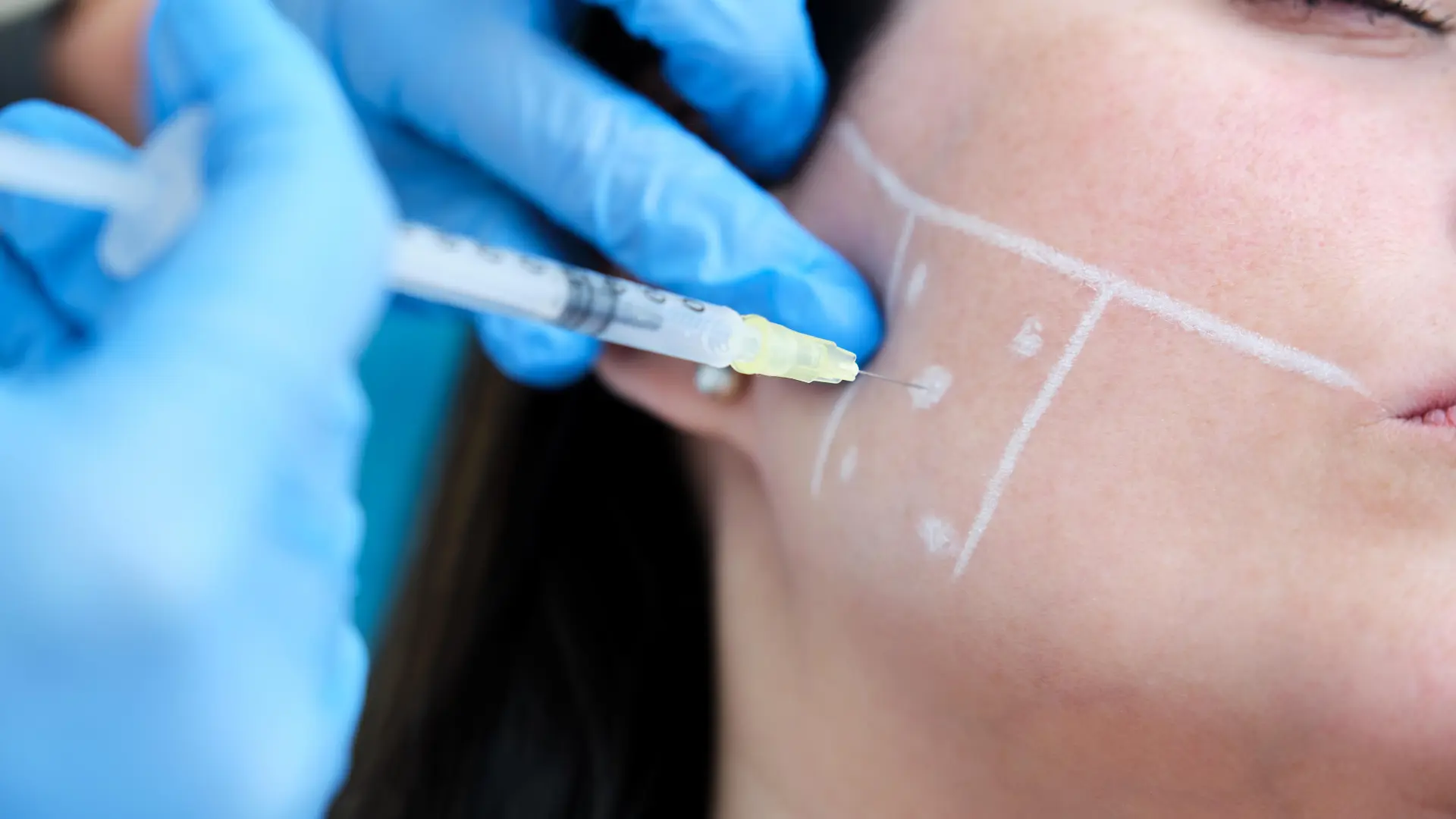 Cómo puede ayudar la toxina botulínica a disminuir los síntomas del ...