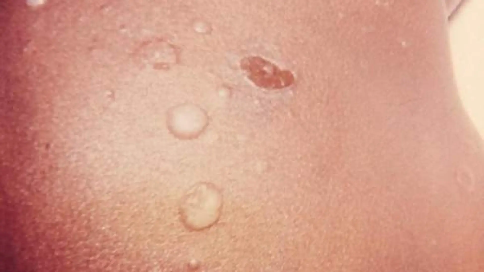 Estos son los síntomas de las piodermitis, una de las causas más ...