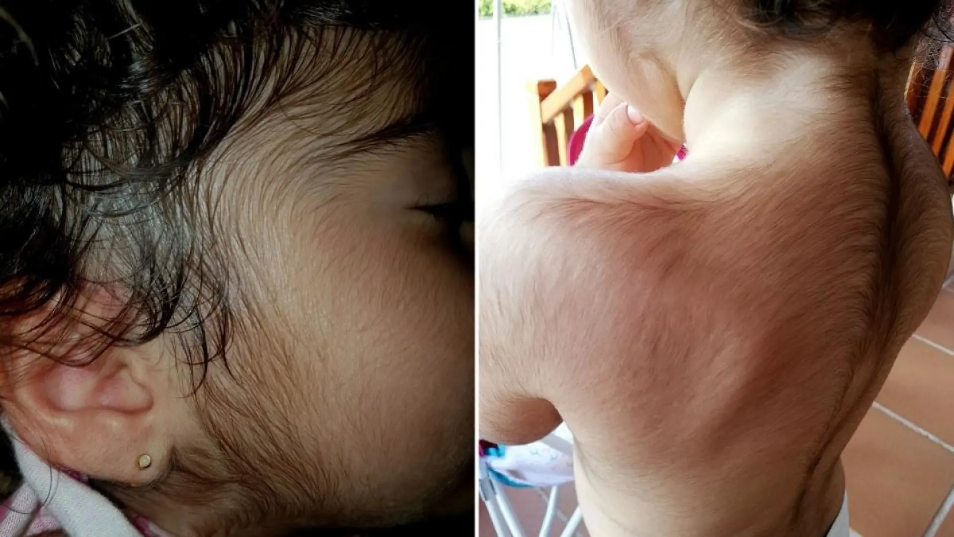 Así es el síndrome del Hombre Lobo: cuando el vello corporal puede ...