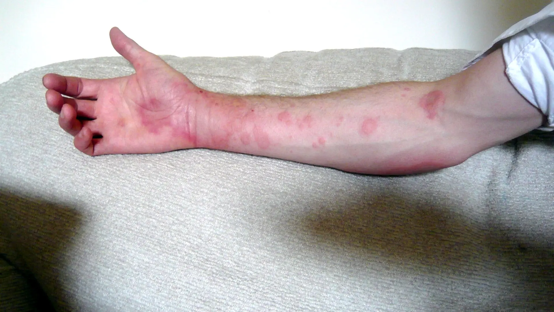 ¿Por qué me salen ronchas en la piel? Causas, síntomas y tratamiento