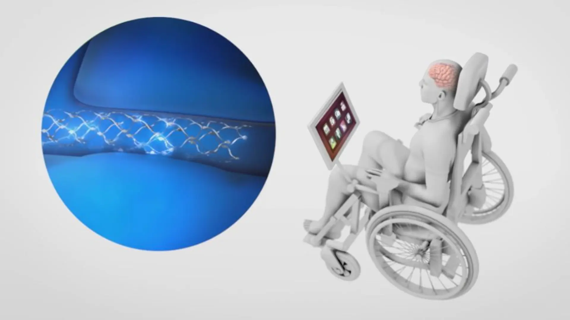 Synchron Stentrode, el implante que permite enviar mensajes de WhatsApp ...