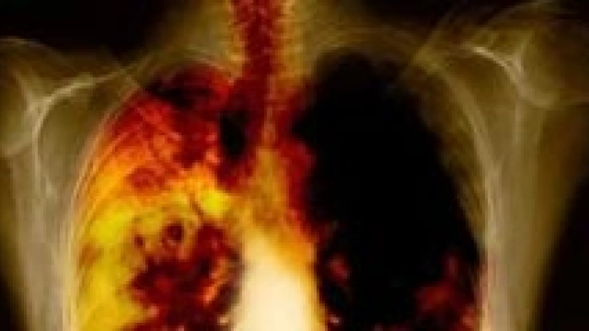 Hallan por primera vez unos cromosomas que predisponen al cáncer de pulmón