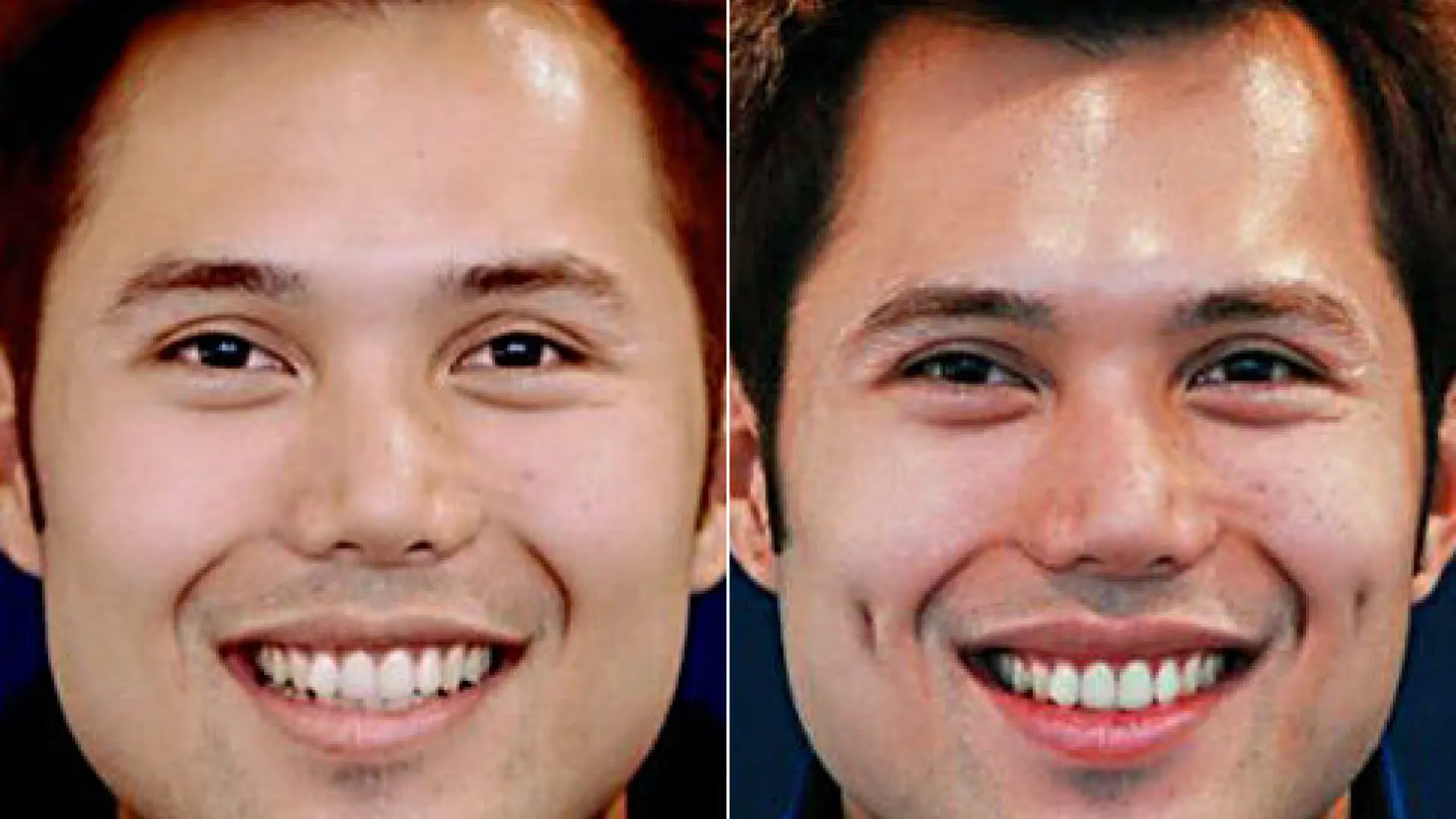 Los médicos advierten que ponerse hoyuelos con cirugía puede provocar desastres estéticos ...