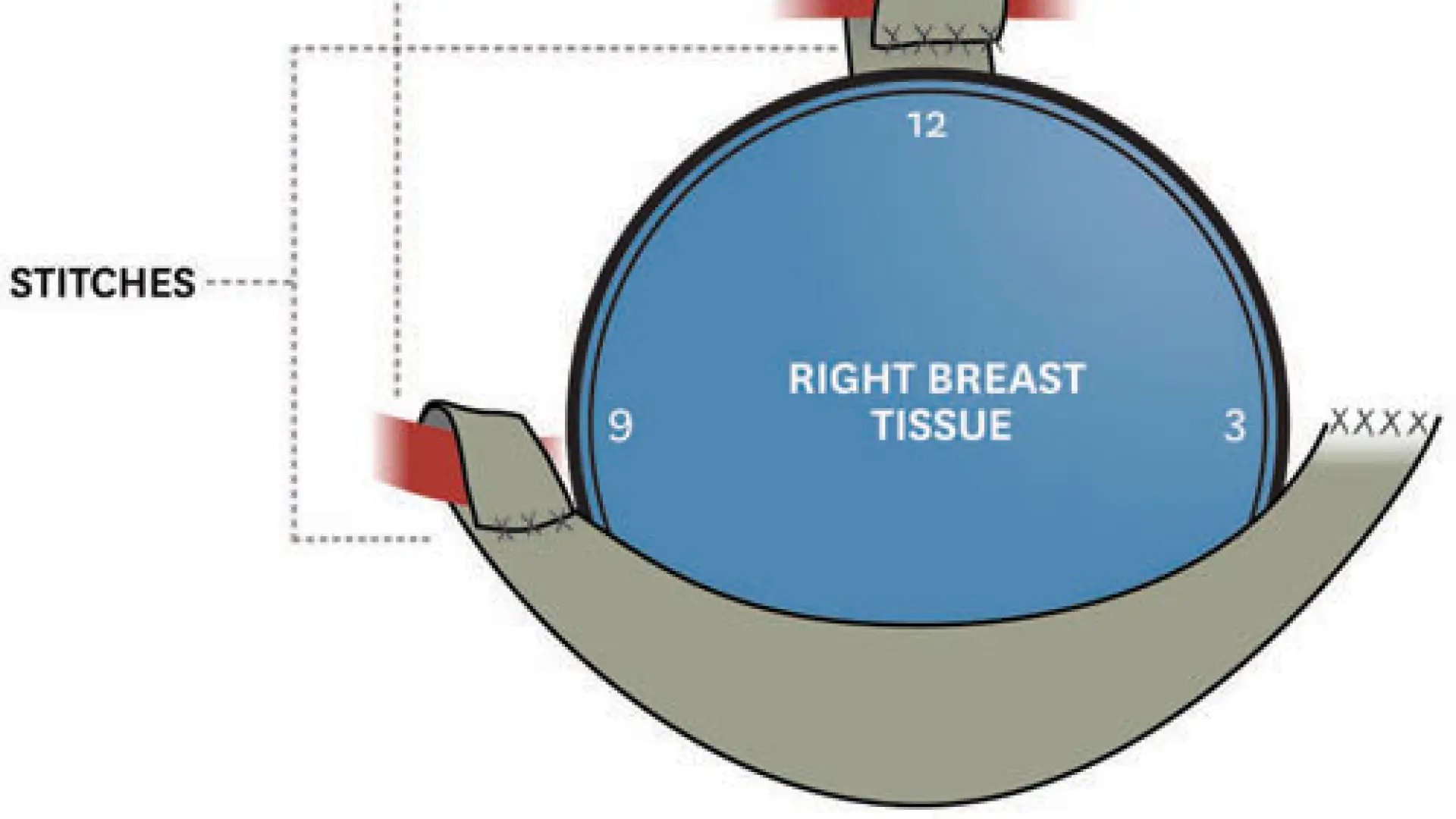 Para lograr la teta ideal hay que pensar como un ingeniero | Opinión de ...