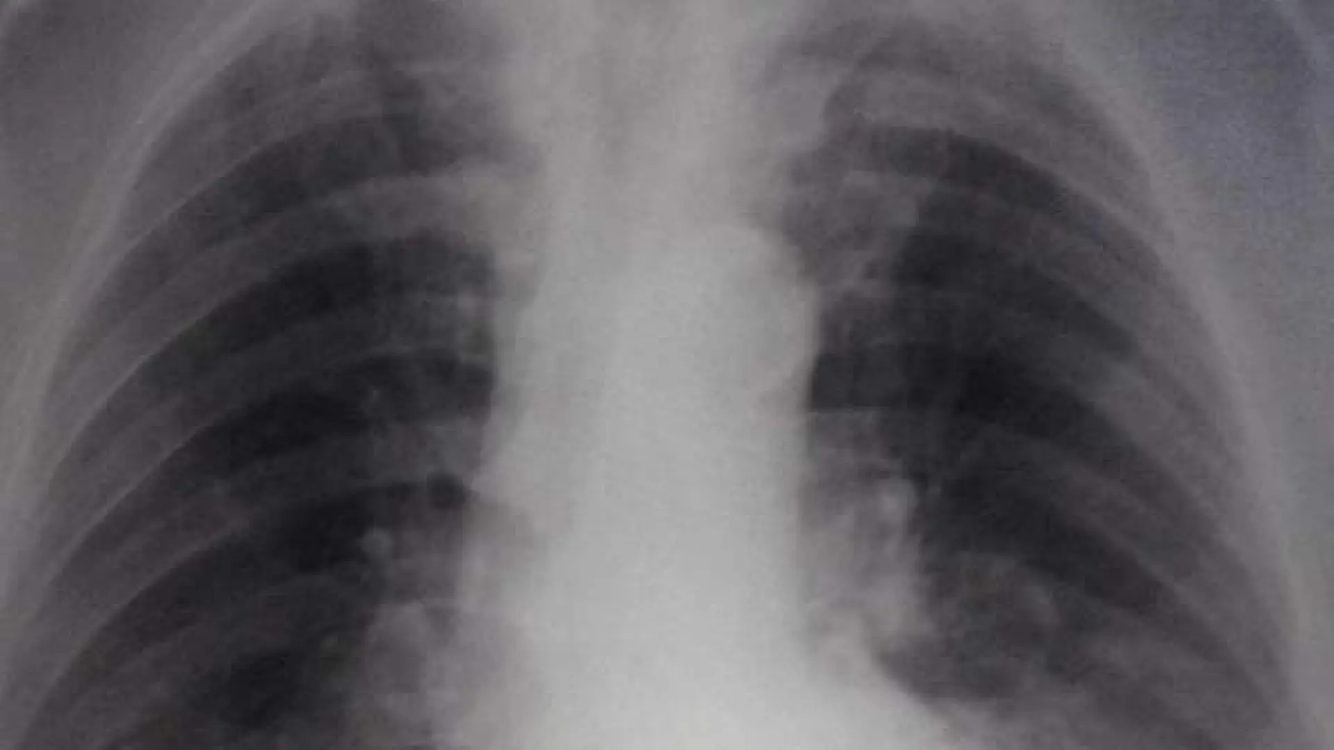 ¿Qué es y para qué sirve un broncodilatador?