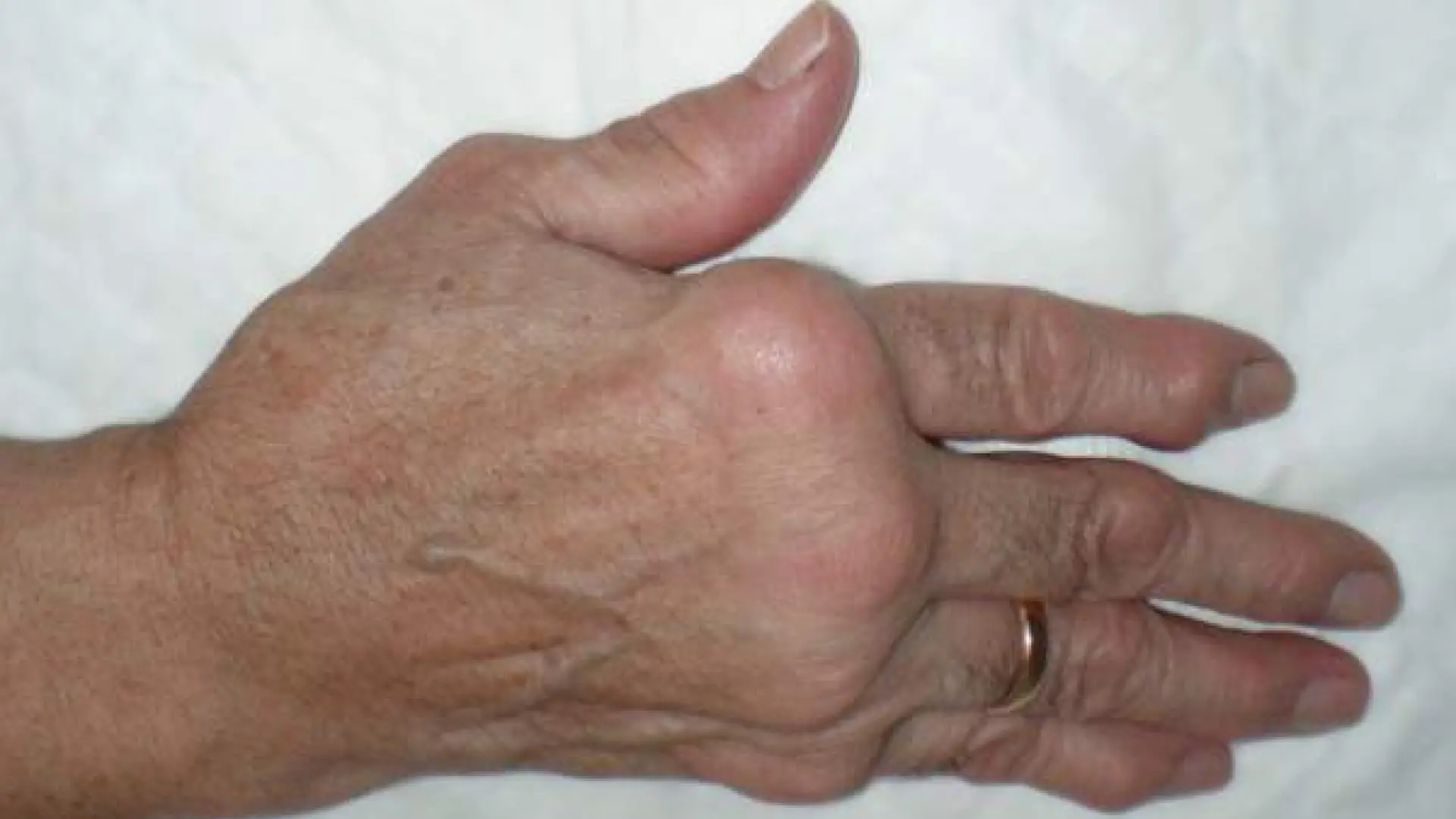 ¿Qué es el síndrome de Reiter? Causas, síntomas y tratamiento