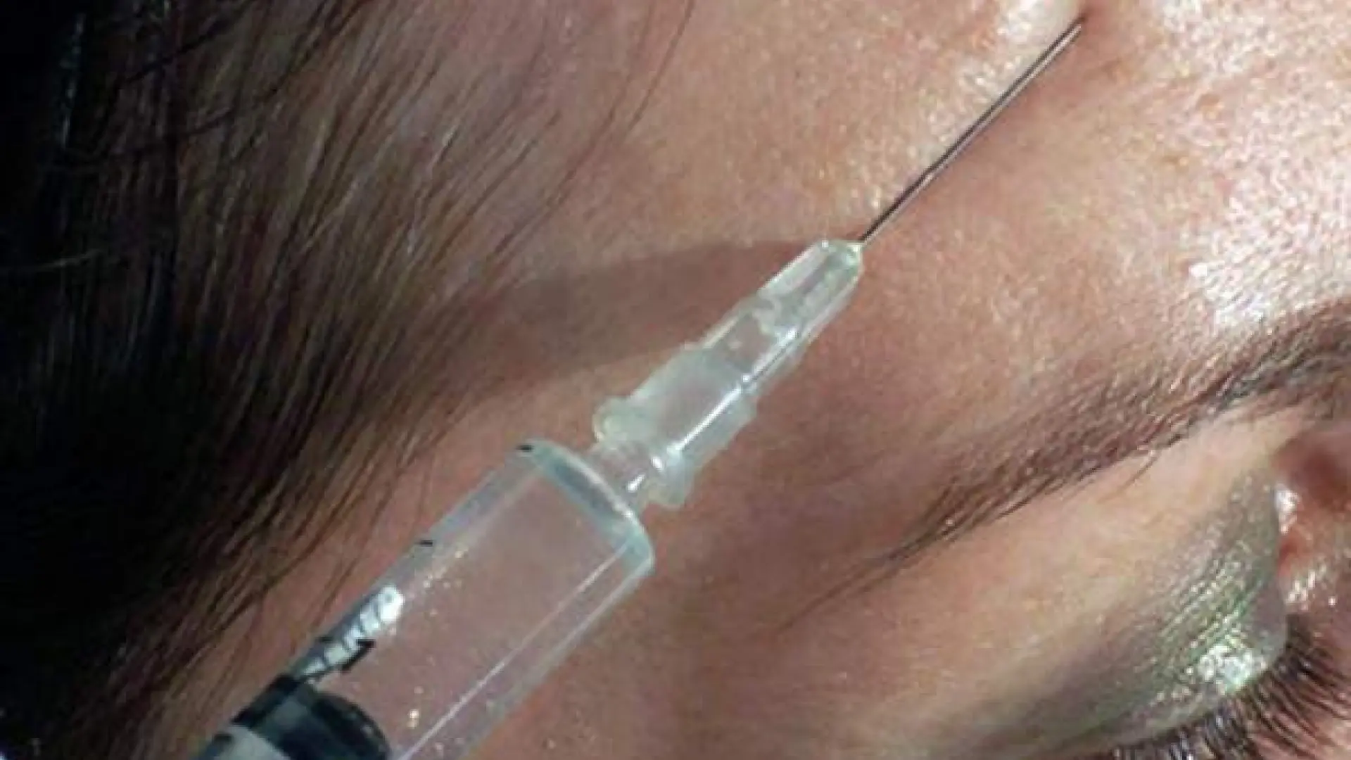 El ‘Botox’, 20 años en España: lo de menos es la estética