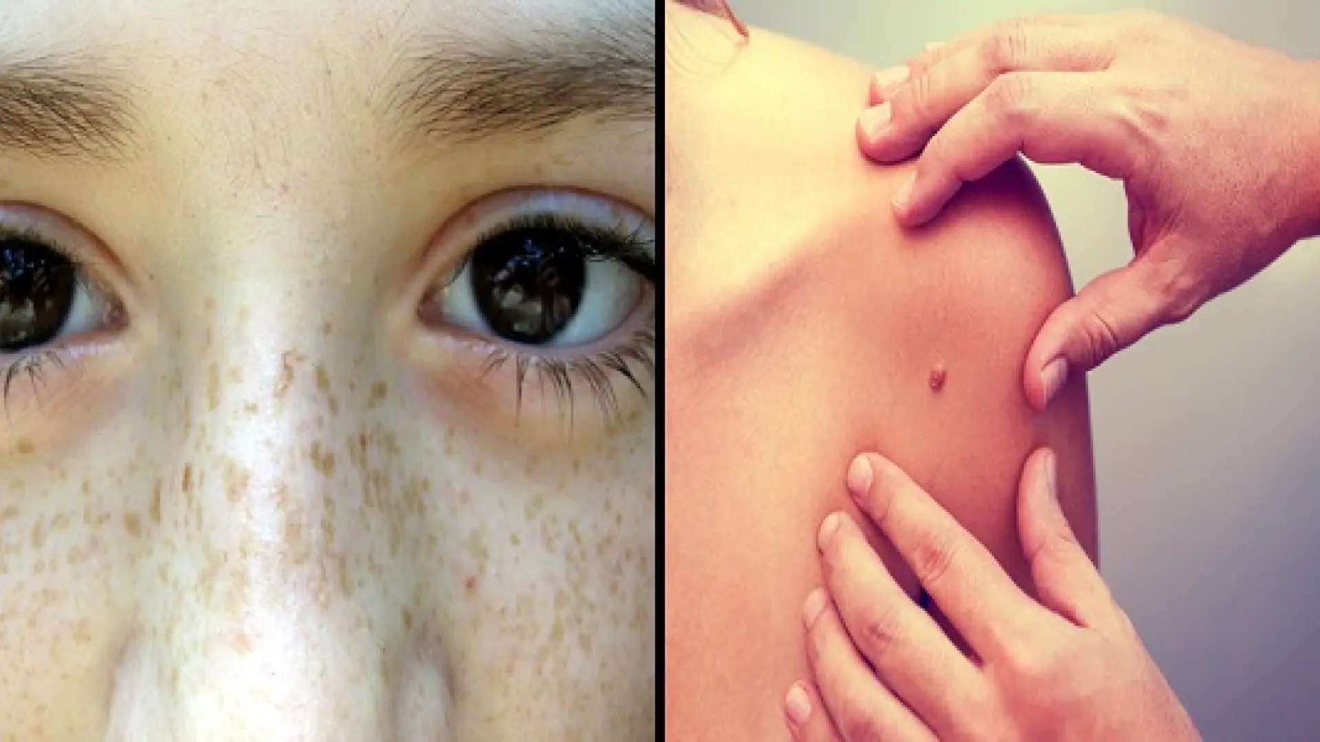 ¿Por qué a algunas manchas de la piel se les llama ‘peca’ y a otras ...