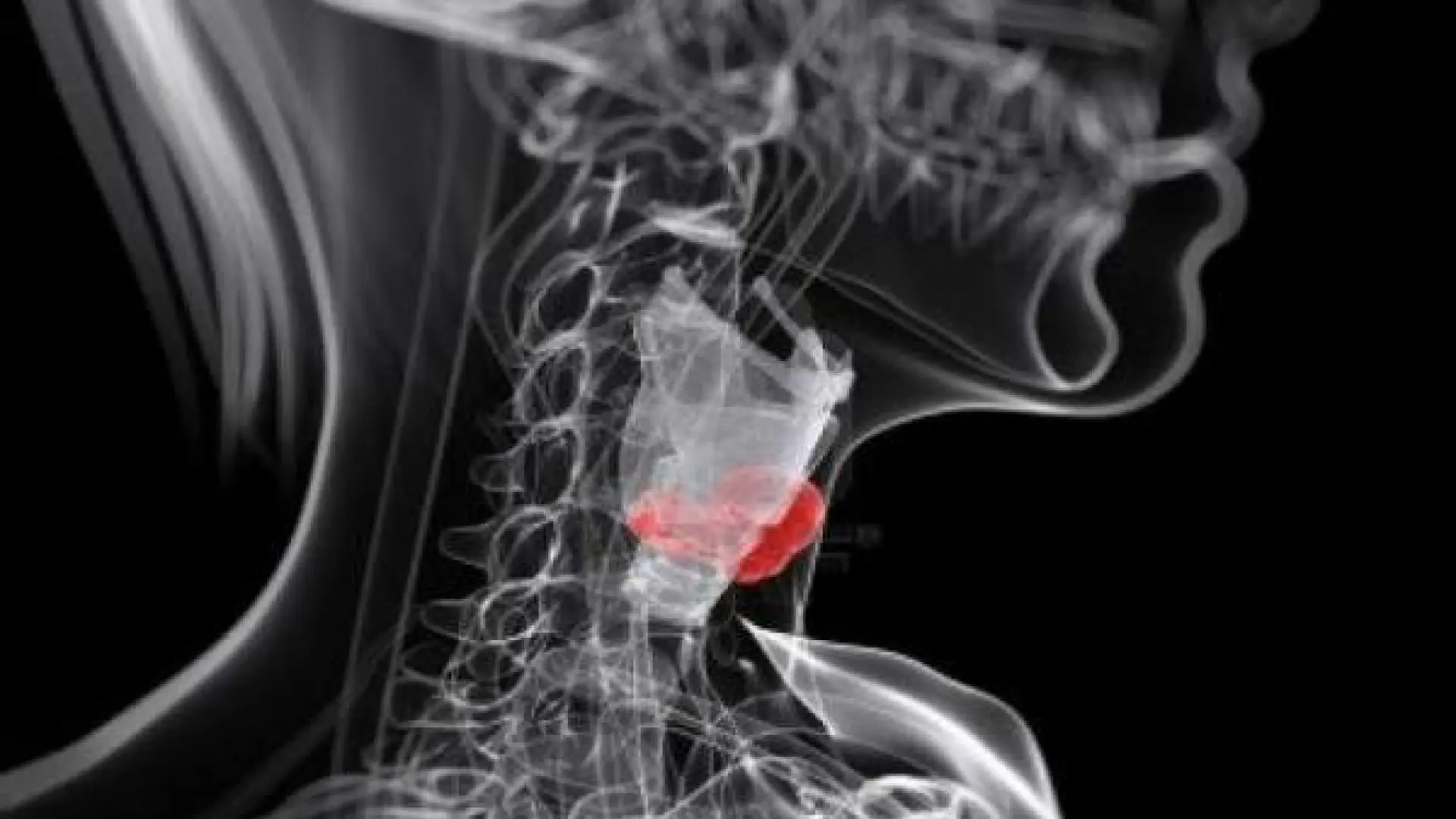 El Hospital Can Ruti practica la primera laringectomía total con robot ...