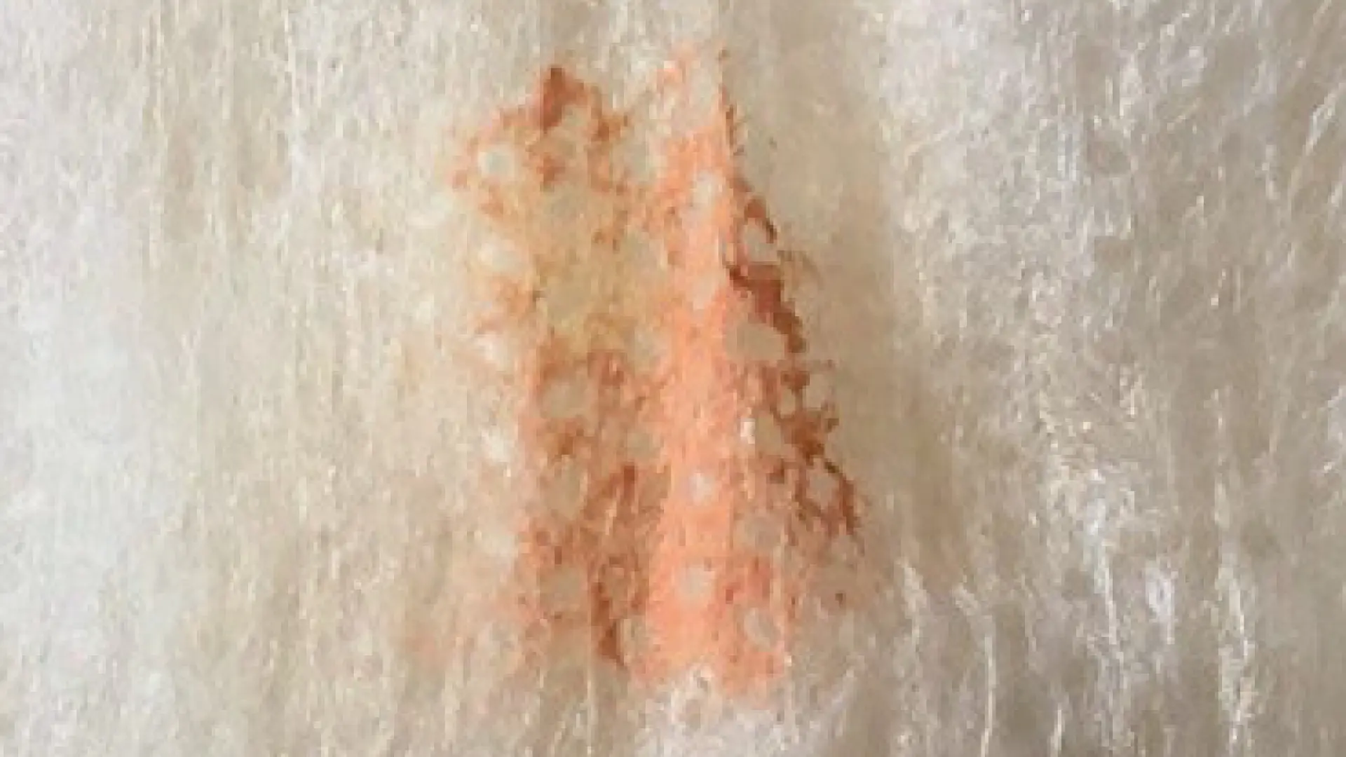 Uratos amorfos: bebés que hacen "pis con sangre"