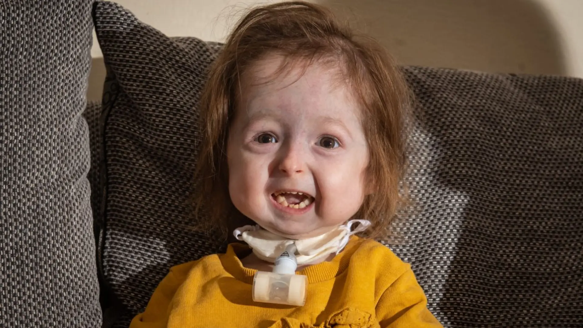 Una niña de dos años con la 'enfermedad de Benjamin Button' tiene una ...