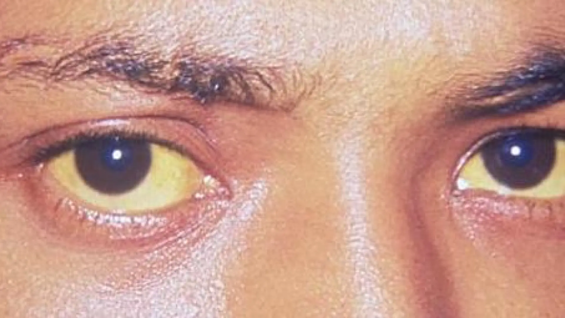 Estos son los síntomas de la insuficiencia hepática, una complicación ...