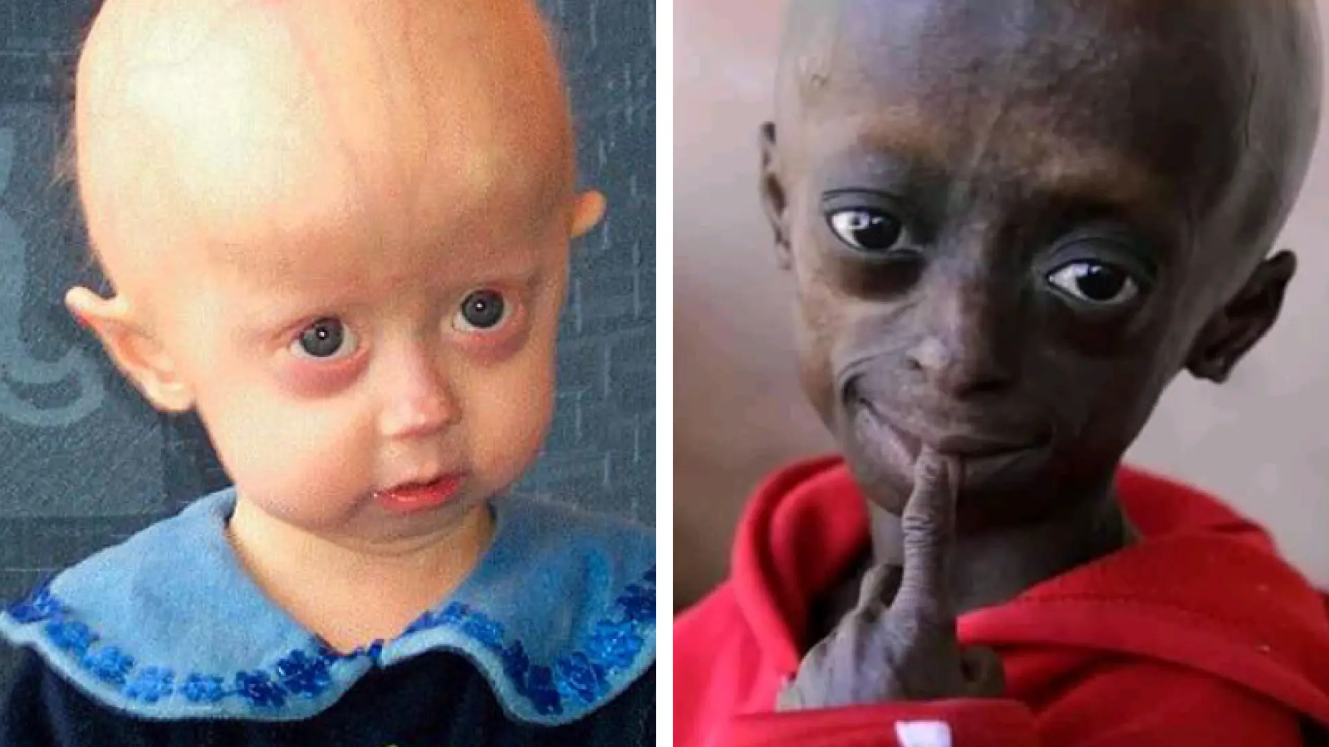 Progeria En Adultos