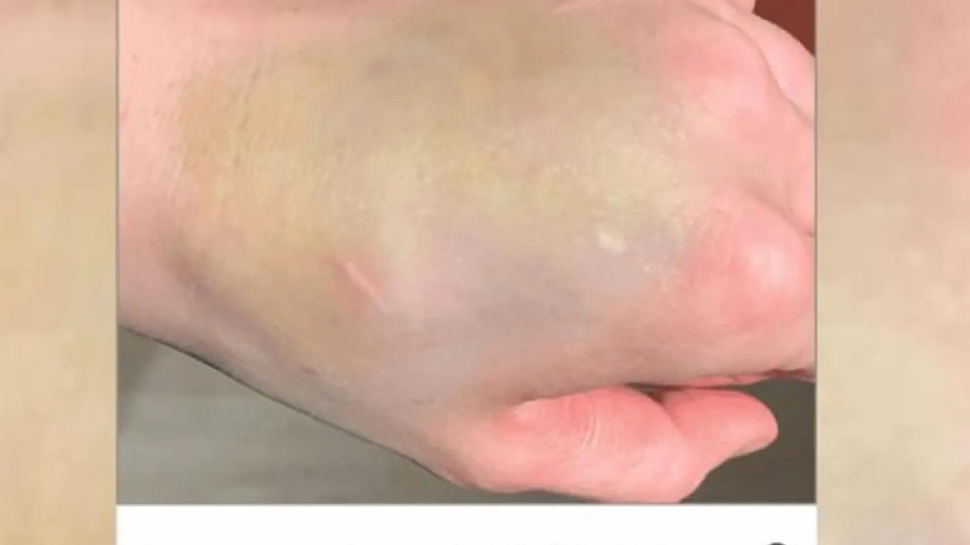 Acude al médico con un moratón en la mano y descubre que tiene un tumor