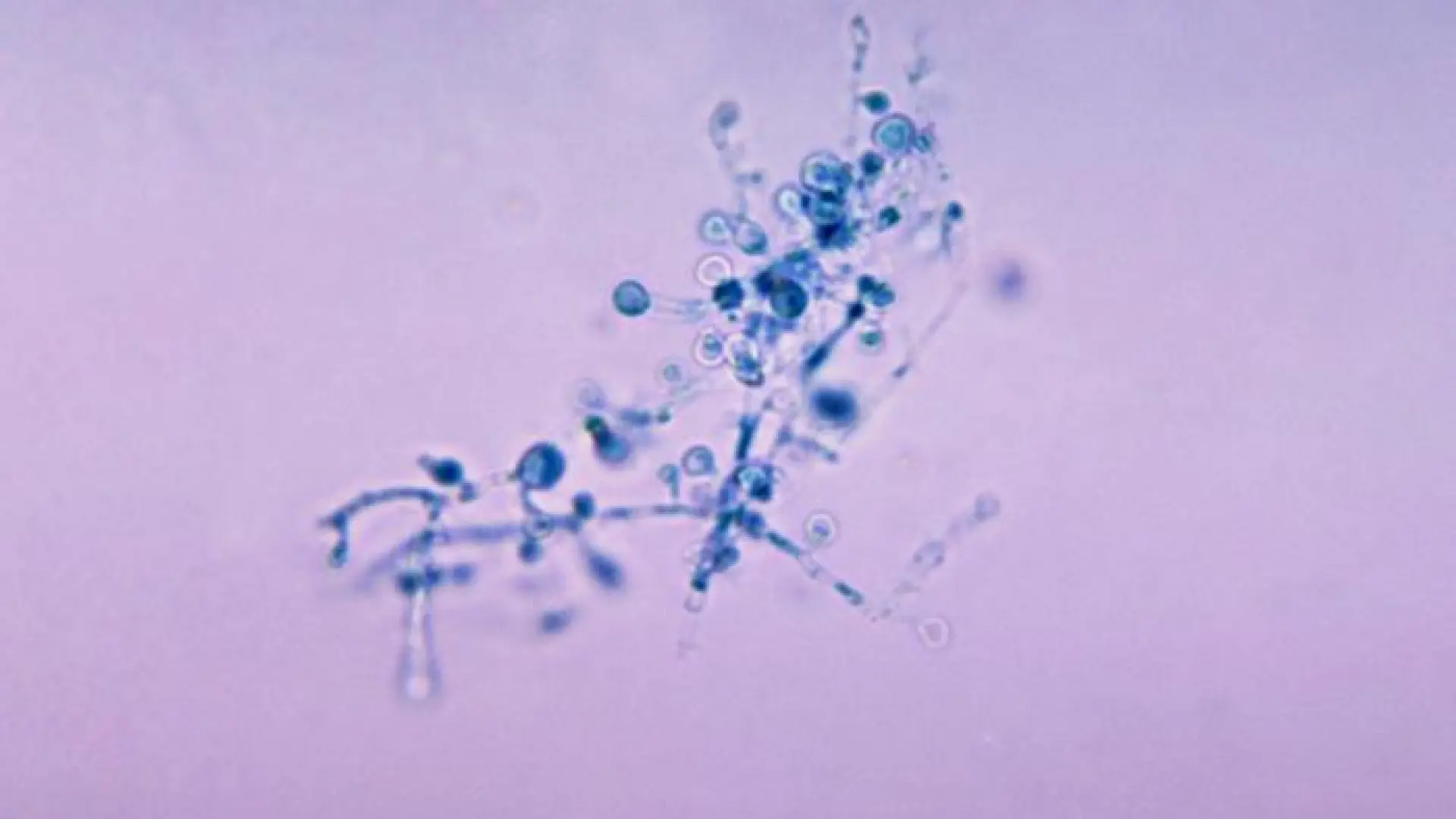 Blastomicosis, la enfermedad causada por un hongo que se ha detectado ...