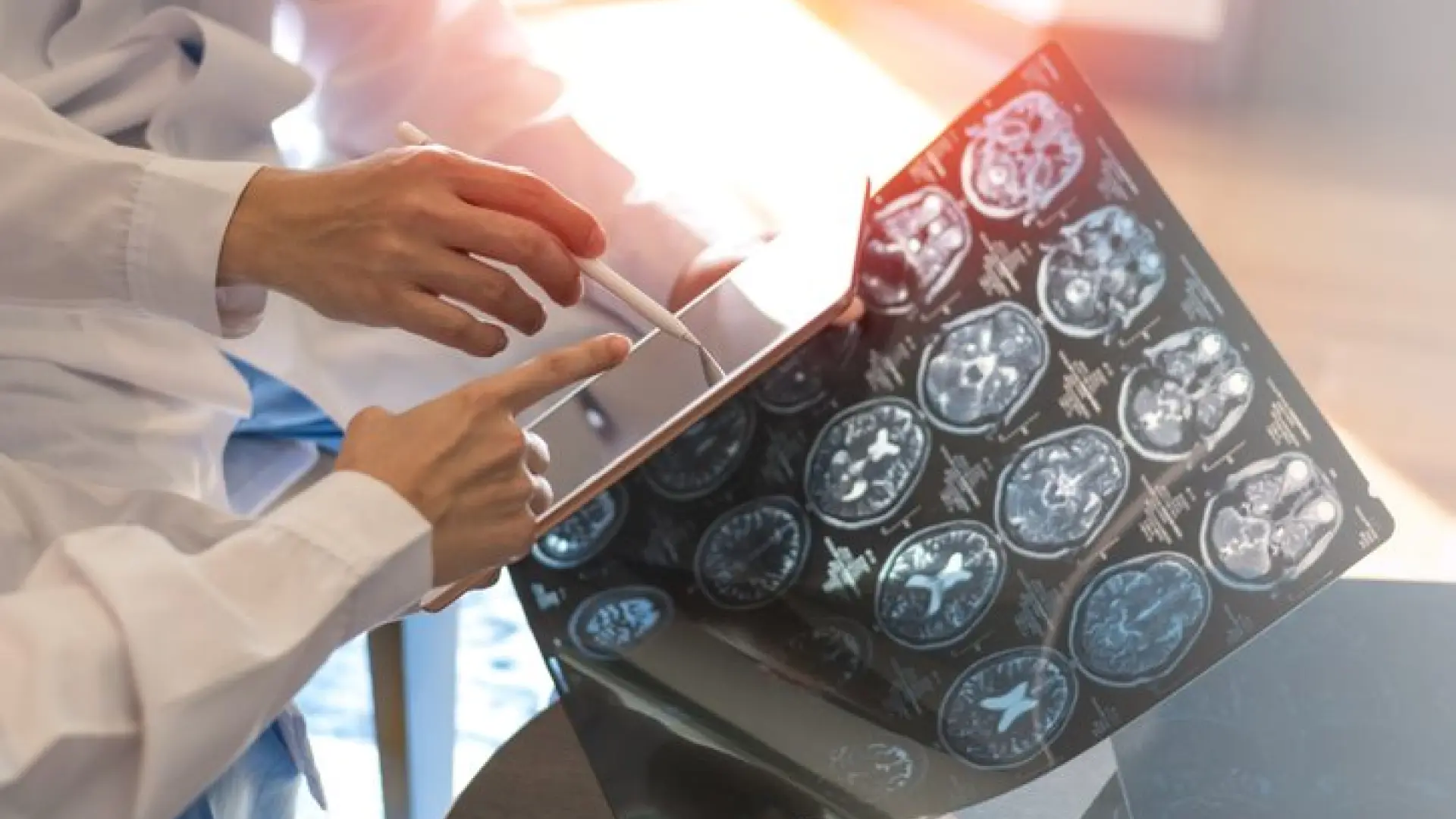 Esclerosis múltiple: cómo detectarla a tiempo, síntomas y la posible vacuna