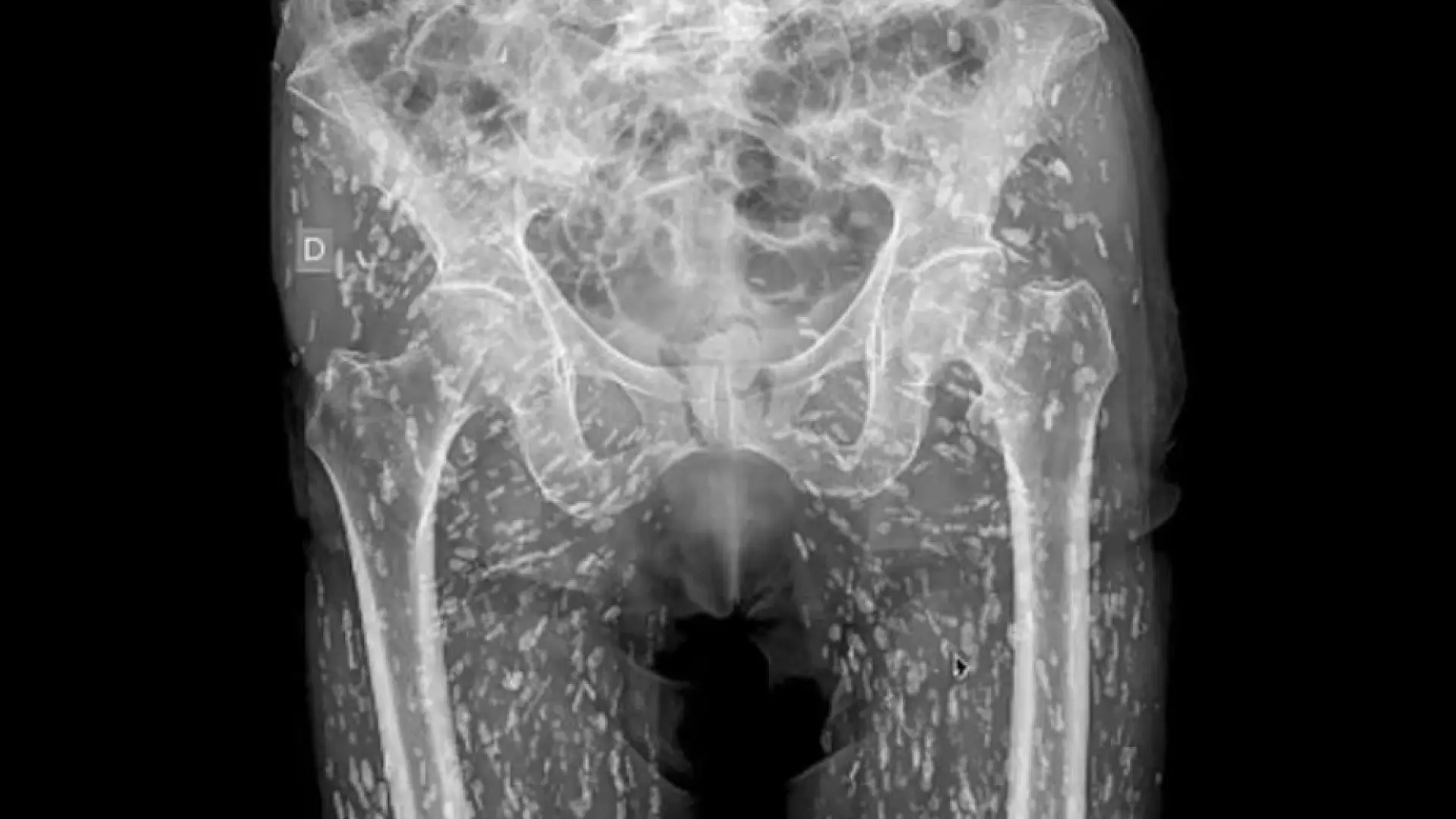 La aterradora radiografía de un hombre con una infección de parásitos ...