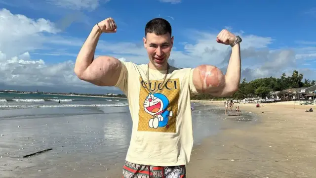 El 'Popeye ruso' podría sufrir la amputación de ambos brazos tras años ...