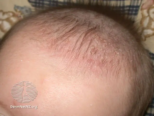 Costra láctea, dermatitis seborreica y caspa ¿Es todo lo mismo?