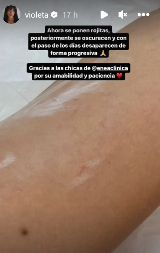 Violeta Mangriñán pone fin a uno de sus complejos físicos: "No os echaré de menos"