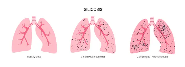 Silicosis, la 'epidemia silenciosa' que crece en España por las encimeras de cuarzo: estos son ...