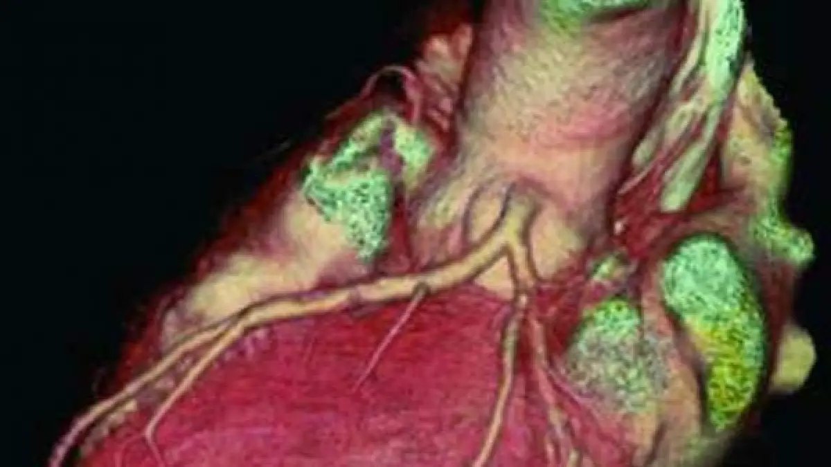 La cardiopatía isquémica es la primera causa de muerte en el mundo ...