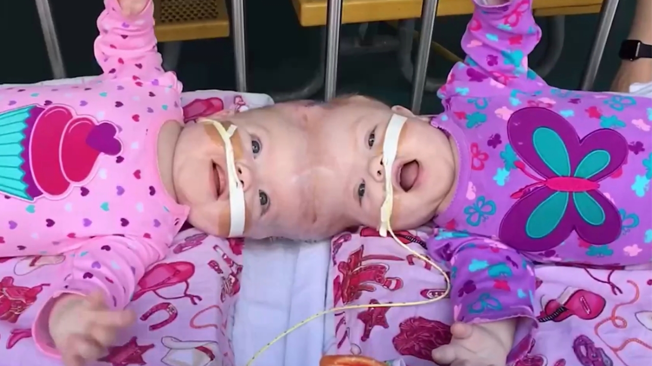 Vídeo: Dos hermanas siamesas, que nacieron unidas por el cráneo ...