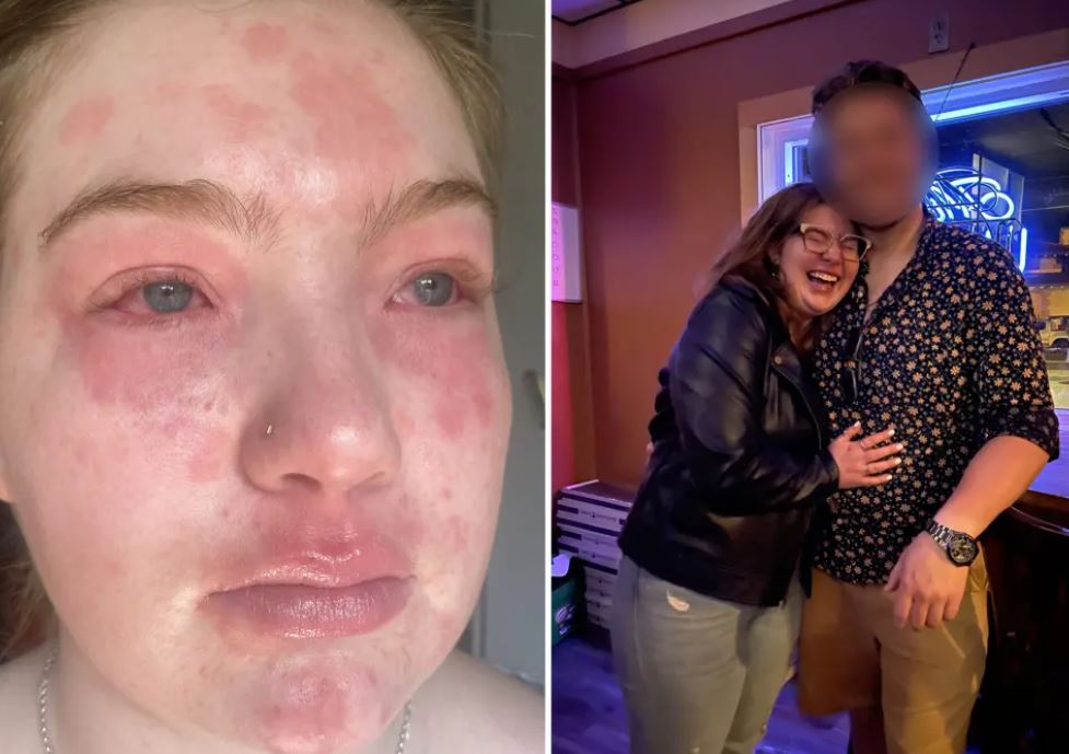 "Soy alérgica a mi novio": la historia de una joven con extraños ...